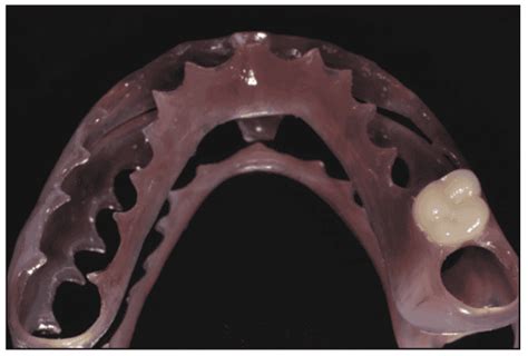 Removable Gingival Prosthesis A Digital Workflow For A Traditional