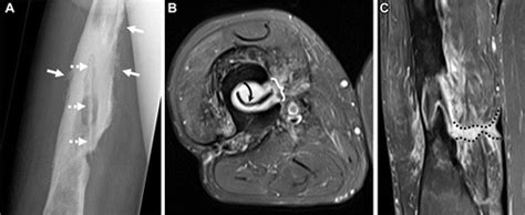 Periosteal Pathologic Conditions Imaging Findings And Pathophysiology