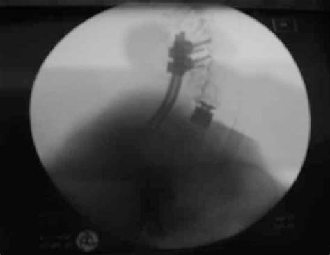 Intraoperative Fluoroscopy Download Scientific Diagram