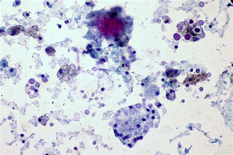 Cryptococcosis Smear From Lung Fna Pap Stain Of Direct Sm Flickr