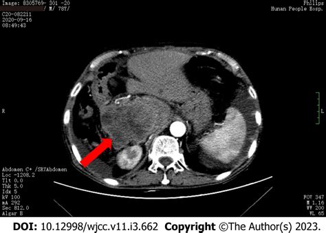 Relapsed Primary Extraskeletal Osteosarcoma Of Liver A Case Report And Review Of Literature