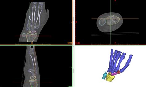 Do 3d Models From Ct Scan Dicom Using Materialise Mimics By Gopalmandal