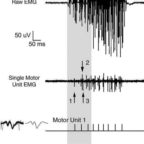 Sample Single Motor Unit Recordings With Compound Emg Activity During Download Scientific