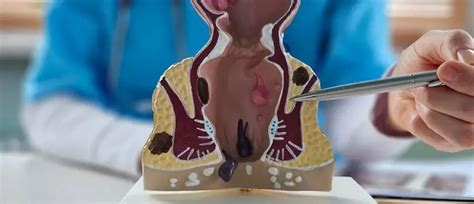 Rectal Bleeding Causes And Treatment In Bangladesh