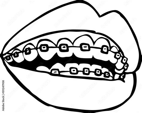 Braces On The Teeth Medical Dentist Checkup In Dental Clinic Tooth