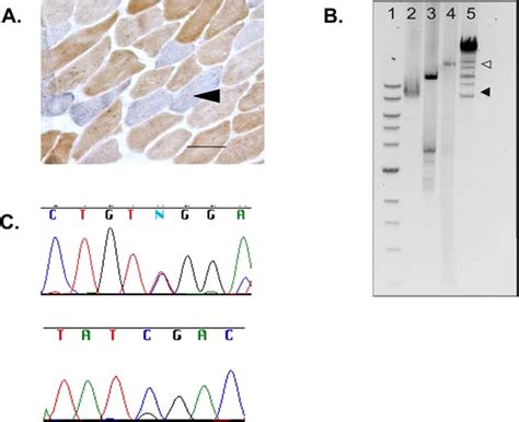 Novel Polg1 Mutations In A Patient With Adult Onset Progressive