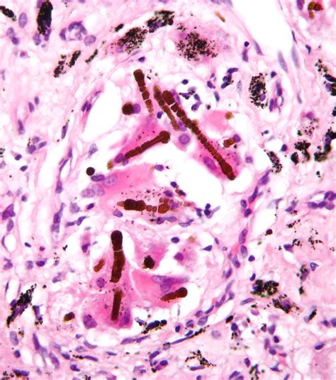Asbestosis Histology
