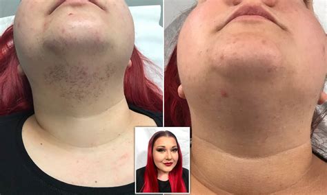 Causes Of Chin Hair How To Get Rid Of Chin Hair 10 Chin Hair Removal