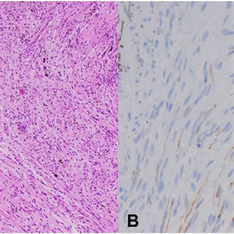 A The Bulk Of The Tumor Is Composed Of Spindled Cells With Mild Download Scientific Diagram