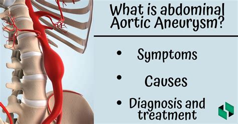 What Is Abdominal Aortic Aneurysm Hti Centers Medical Tourism Center