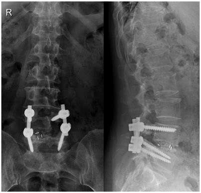 Frontiers Case Report Surgical Treatment Of Lumbar Ligamentum Flavum