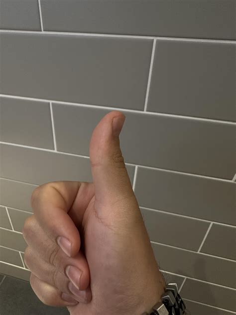 Does This Look Like Cellulitis R Bugbites