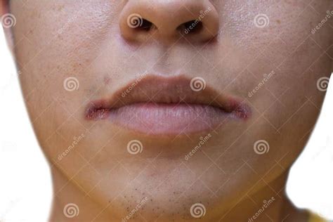 Angular Stomatitis Or Angular Cheilitis Or Perleche In Asian Man Mouth