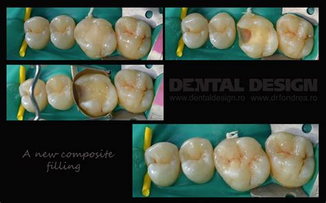 How Is A Composite Filling Made Dr Bogdan Fondrea How Is A Composite Filling Made Dr Bogdan Fondrea