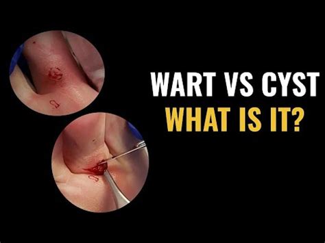 Wart Vs Cyst Removal YouTube