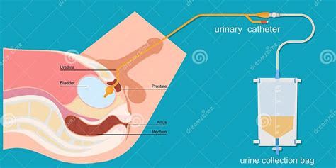 Urinary Catheter In The Male Body With Urinary Bag Stock Illustration