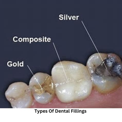 Cavity Filling Everything You Need To Know To Prevent Tooth Damage