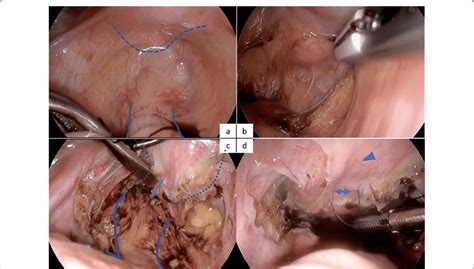 Laparoscopic View Of The Radical Surgery A Uterus Dashed Line And