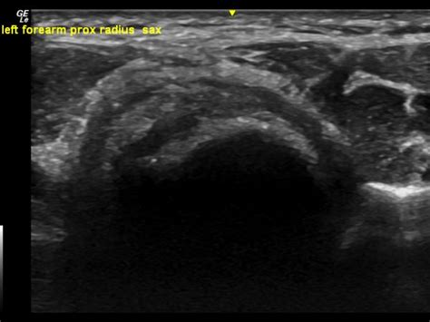 Fall With Proximal Radius Fracture Ultrasound Cases