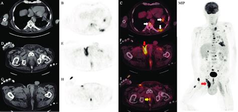A Year Old Man Who Was Diagnosed With Neuroendocrine Tumor Grade Download Scientific