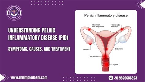Pelvic Inflammatory Disease Pid Symptoms Causes And Treatment