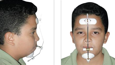 Face Mask Orthodontic Treatment At Brayden Cooke Blog