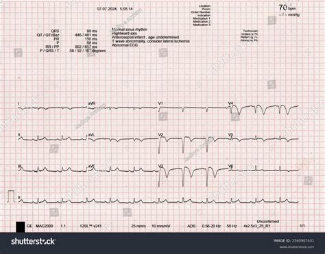 Ecg Stemi Anterior Inferior Pattern Vector Illustration Electrodiagram