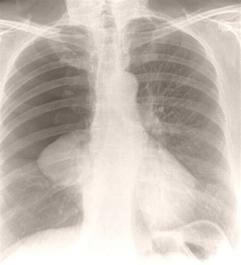 The Interpretation Of Chest X Rays For Pneumothorax Detection A Comprehensive Overview