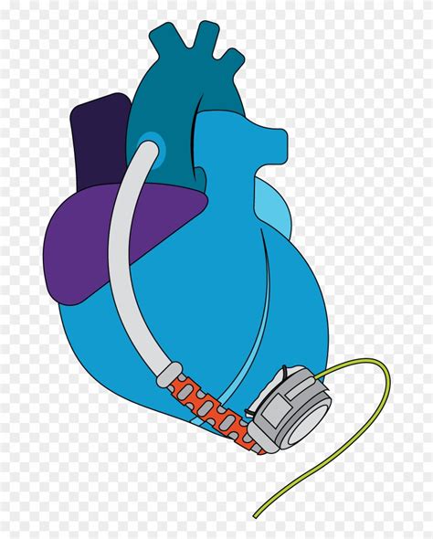 download example of a continuous flow lvad ventricular assist device