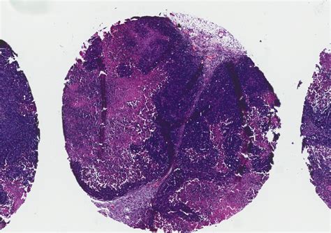 Strange Picture Of Nude Mice Tumor Microarray On Hande And Ihc Researchgate