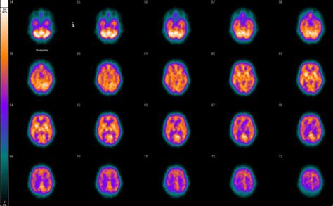 Nuclear Medicine Spect Perfusion Scan Showing Severely Reduced
