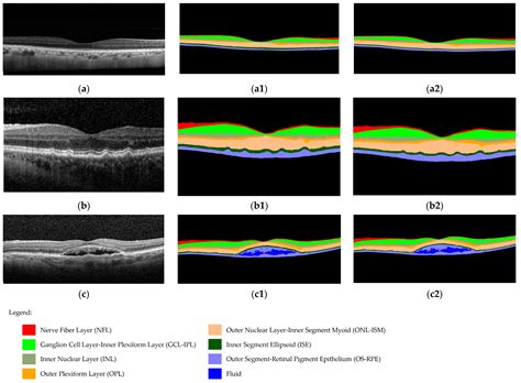 Human Versus Artificial Intelligence Validation Of A Deep Learning Model For Retinal Layer And