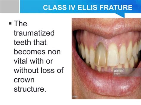 Management Of Ellis Class Iv Fracture Pptx Dental Health Diseases And Conditions