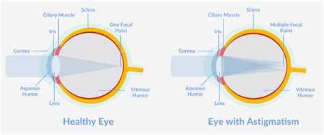 Astigmatism Causes Types Symptoms And Treatment Smartbuyglasses Nz