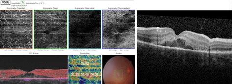 OCT And OCTA Imaging At The 1st Day After Trauma To The Right Eye A Download Scientific