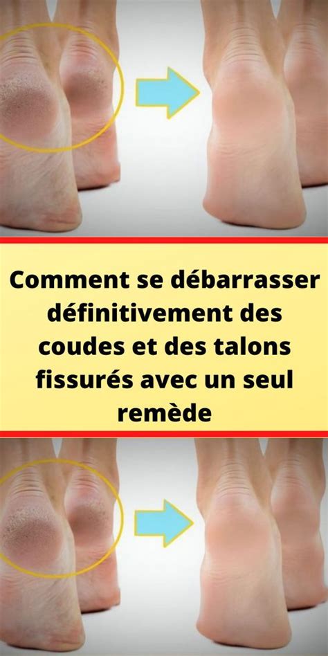 Comment Se Débarrasser Définitivement Des Coudes Et Des Talons Fissurés Avec Un Seul Remède