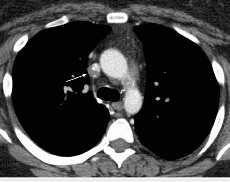 Axial View Of A Ct Chest Showing An Eccentric Partially Calcified