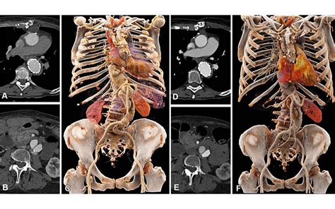 Photon Counting Ct Angiography Rsna