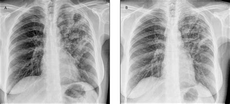 El Regreso Silencioso El Resurgimiento De La Tuberculosis Resistente