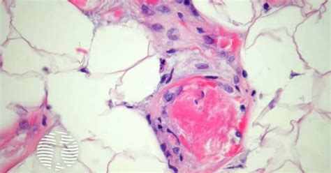 Angiolipoma Pathology Image