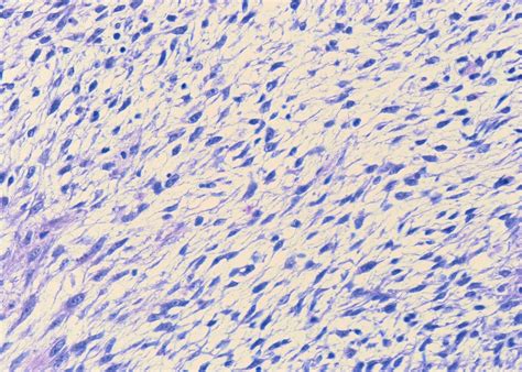 Gist With Myxoid Stroma He Stain Ob 20× Download Scientific Diagram