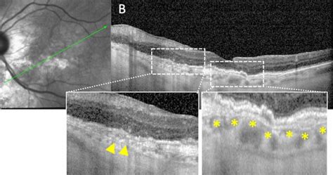 Presumed New Amd Phenotype Found Subclinical Angioid Streaks