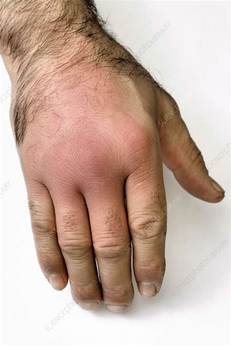 Cellulitis Hand
