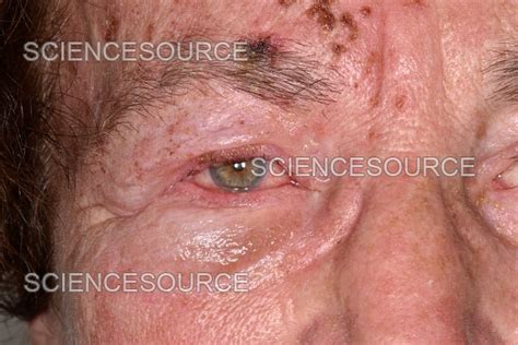 Shingles Eyebrow
