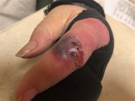Pyoderma Gangrenosum Of Finger Best Wound Practice