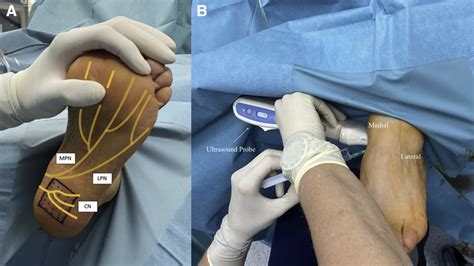 Calcaneal Nerve