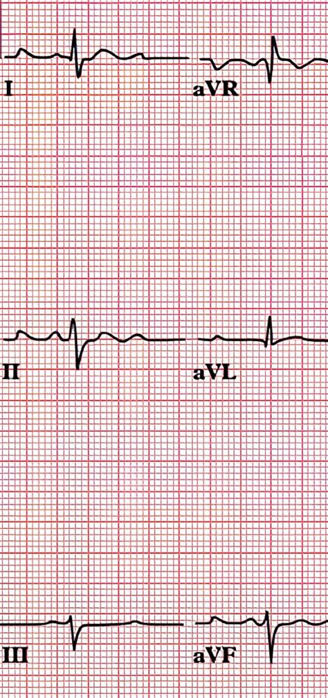 Topic The Cardiac Axis 12 Lead Ecg Course Acls Certification Association