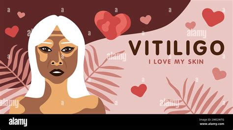 Banner About Vitilingo Skin Disease With Elderly Asian Woman