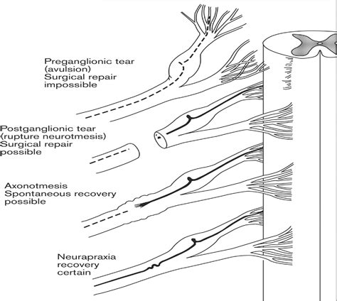 Update On Management Of Pediatric Brachial Plexus Palsy Journal Of Pediatric Orthopaedics B