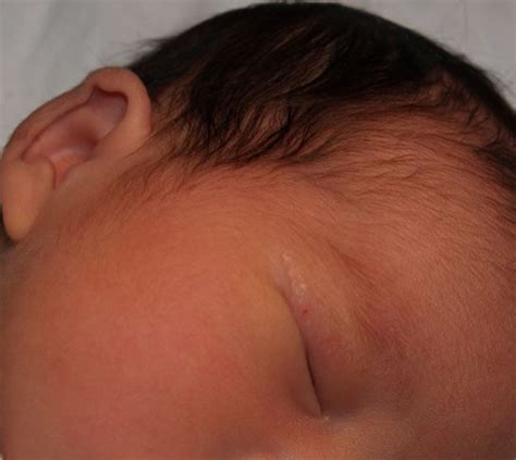 Epidermal Nevus Newborn Racgp Birthmarks Identification And